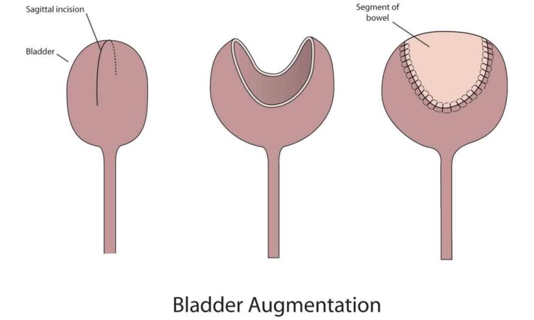 Clean Intermittent Catheterization and Bladder Irrigation, with Jake ...