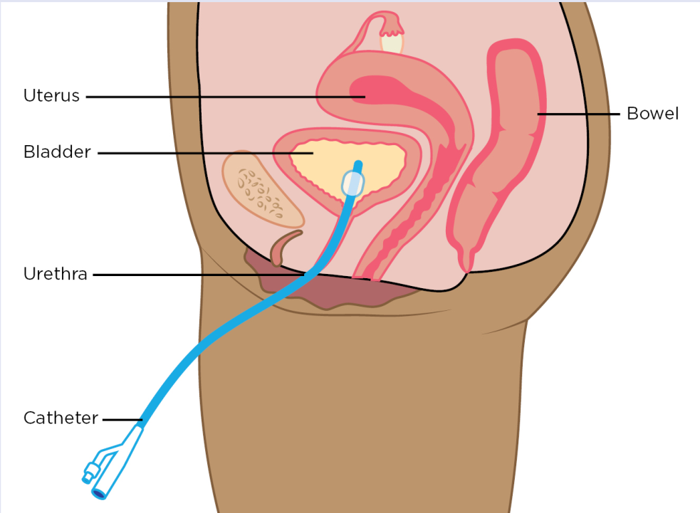 Clean Intermittent Catheterization and Bladder Irrigation, with Jake Klein. ⋆ OKC Kids Urology